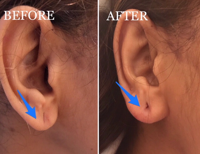Dermal Filler for Ears? – Dr Sabba
